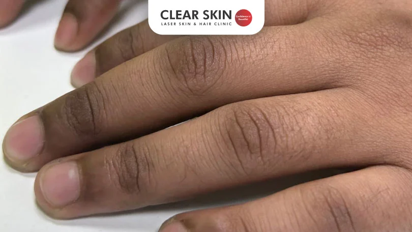 How To Get Rid Of Dark Knuckles Fast And Permanently 