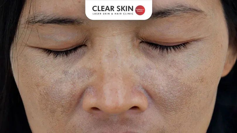 Acanthosis Nigricans Treatment- How to Get Rid of Black Neck?