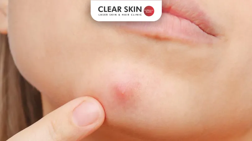 Blind Pimple How Do You Get Rid Of Pimples That Are Under The Skin 