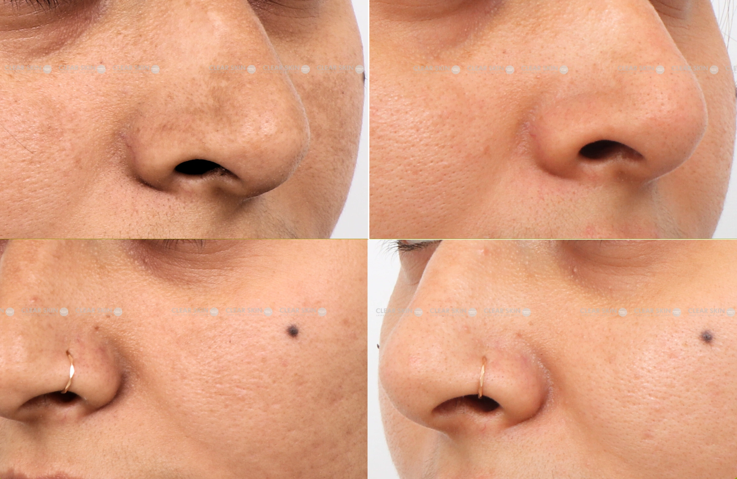 Melasma Treatment | Melasma In Men | Clear Skin Pune