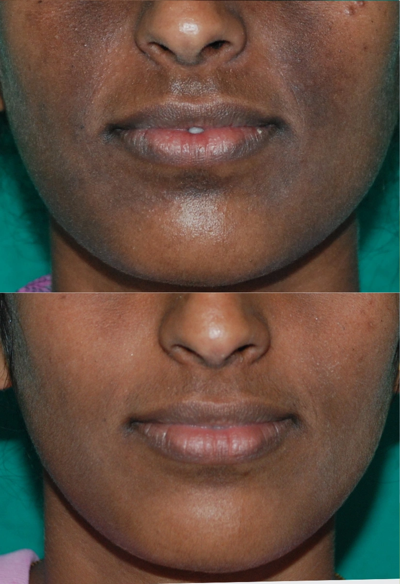 Skin Pigmentation Treatment - Before and After Images