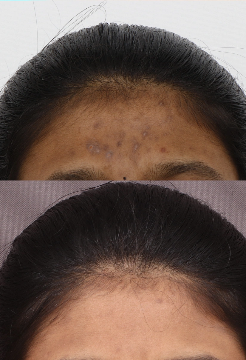 Skin Pigmentation Treatment - Before and After Images
