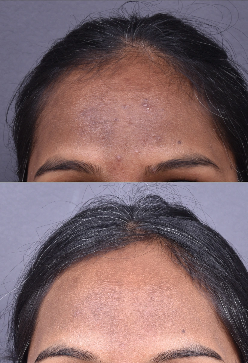 Skin Pigmentation Treatment - Before and After Images