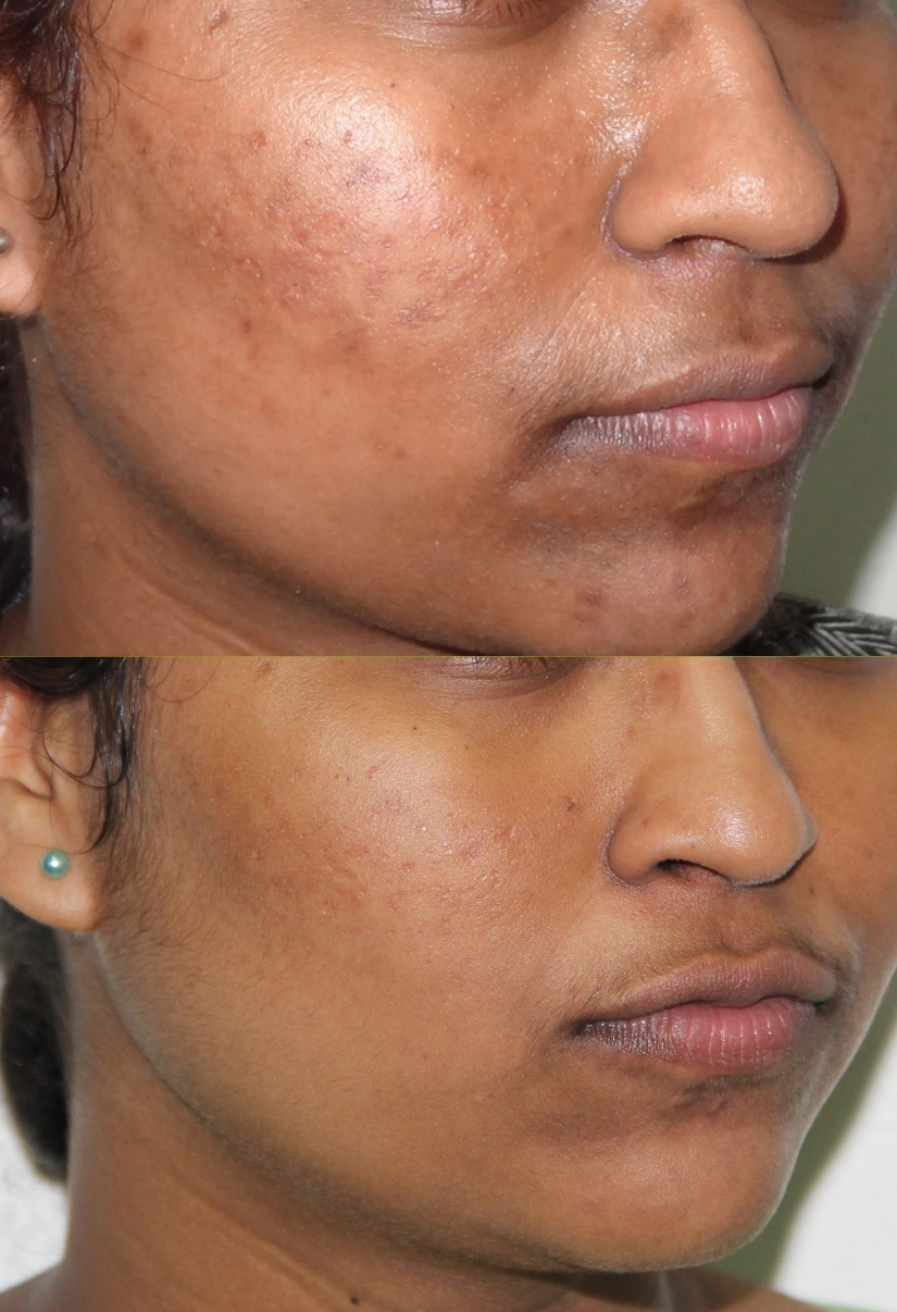 Skin Pigmentation Treatment - Before and After Images