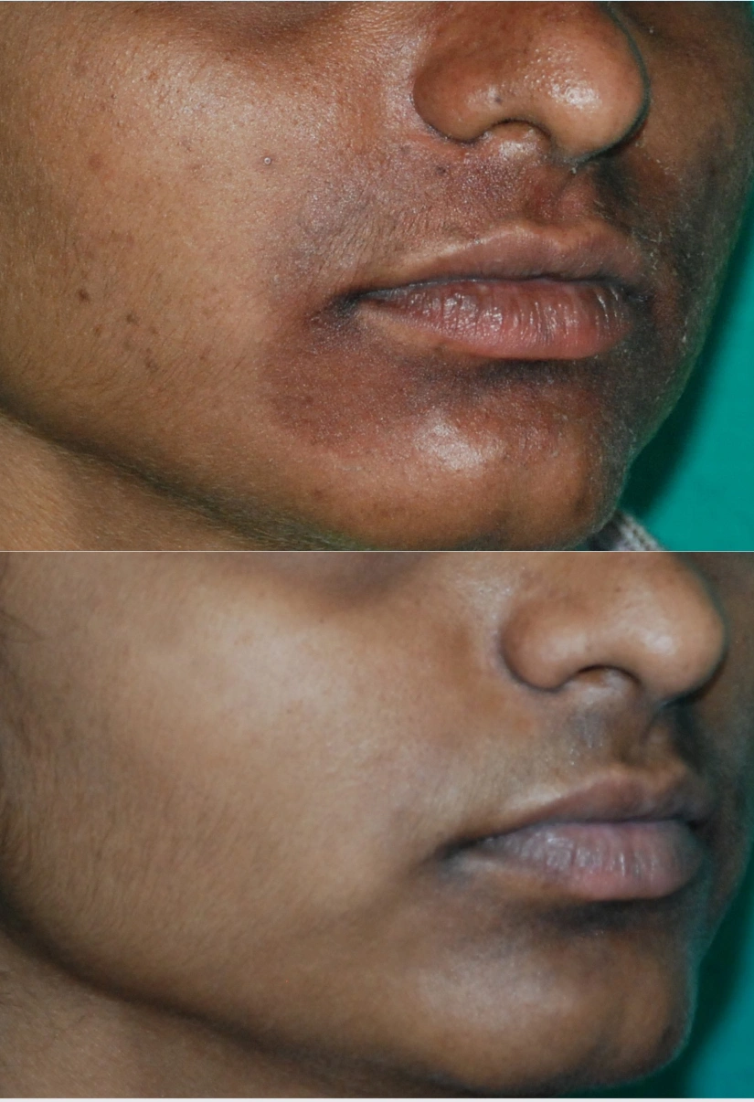 Skin Pigmentation Treatment - Before and After Images
