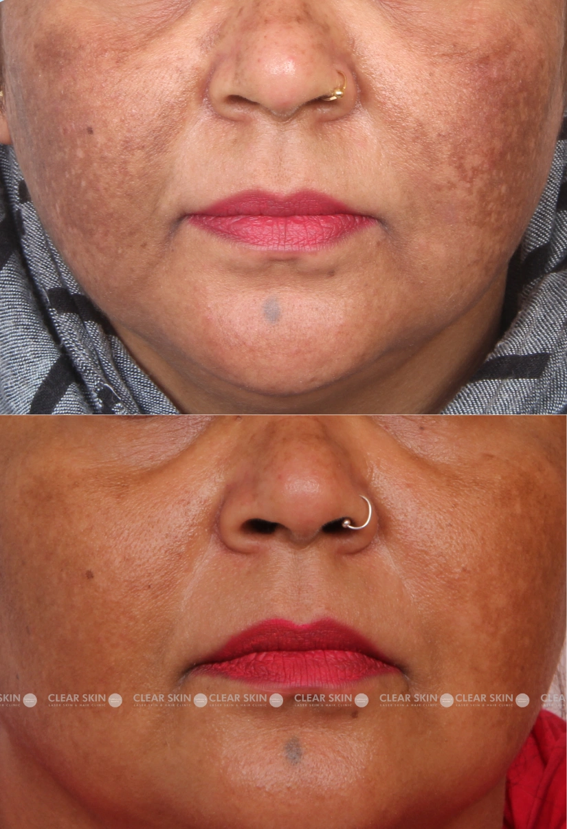 Melasma Treatment Results - Before and After Pictures Clear Skin