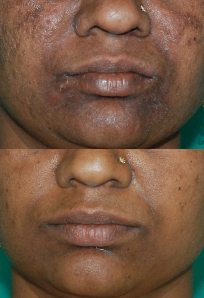 Skin Pigmentation Treatment - Before and After Images