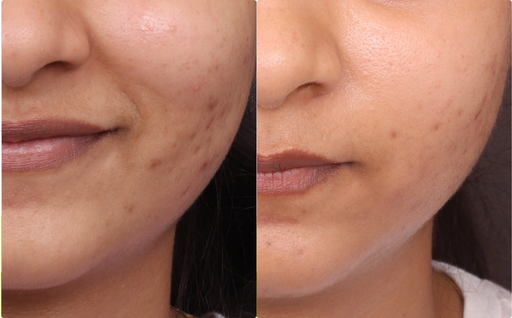 Subcision Treatment in Pune | Clear Skin Clinic