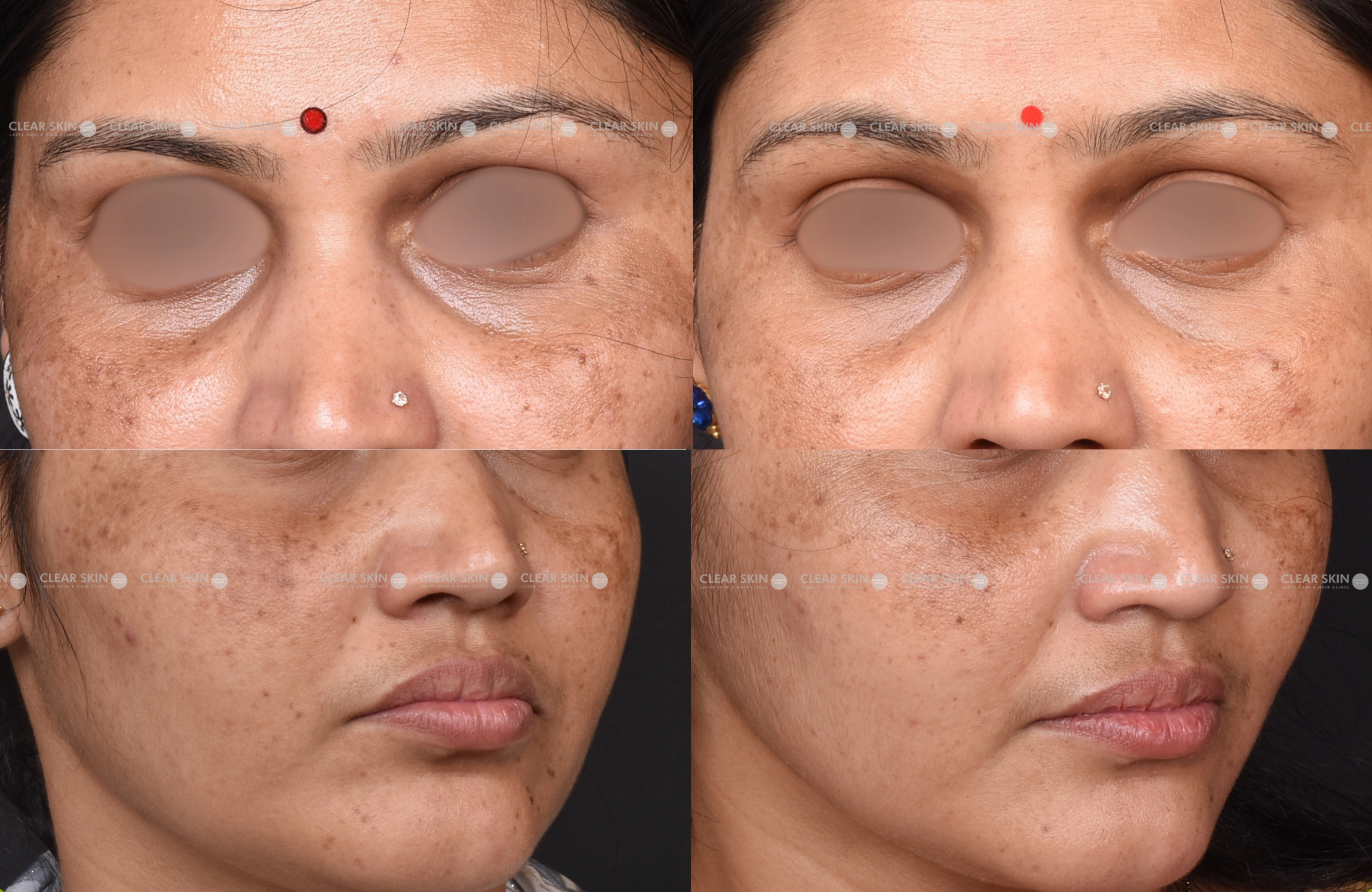 Freckles Removal treatment in Pune | Clear Skin Clinic