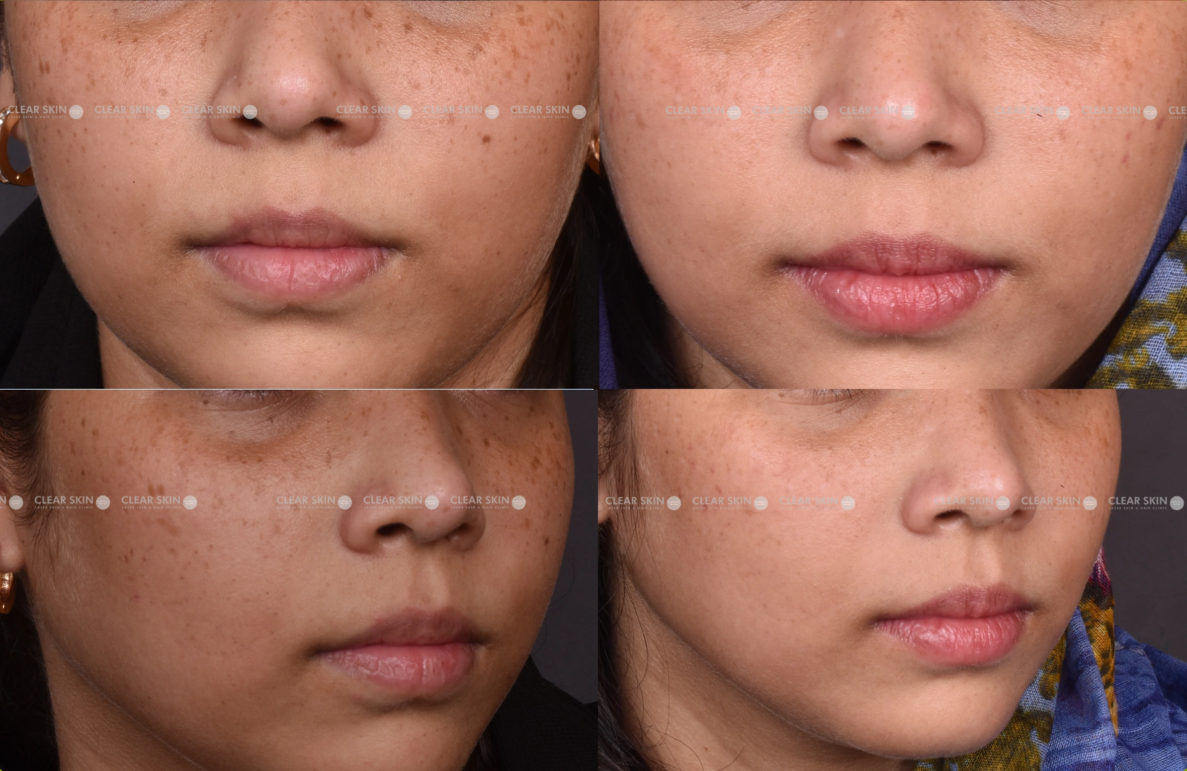 Freckles Removal treatment in Pune | Clear Skin Clinic
