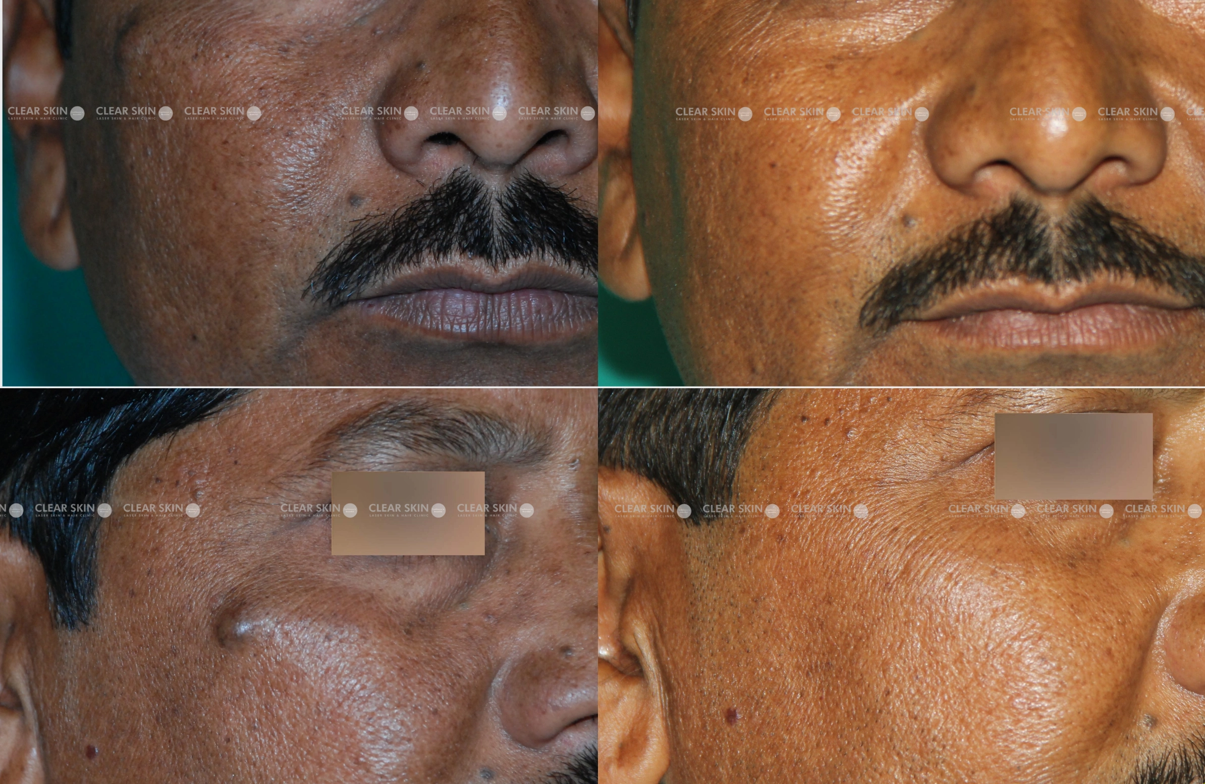 Sebaceous Cyst Treatment Epidermoid Cyst Removal Clear Skin