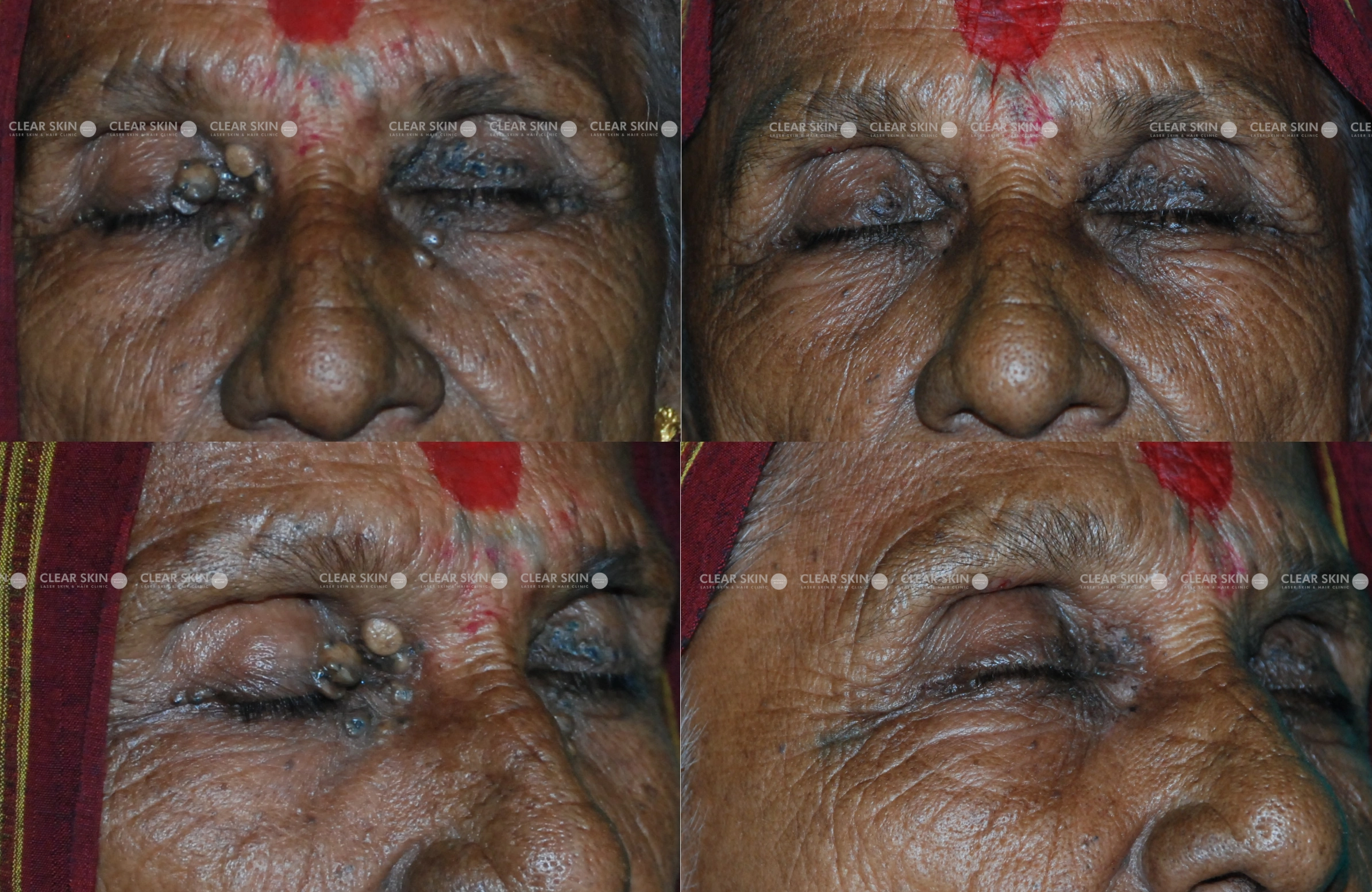 Sebaceous Cyst Treatment Epidermoid Cyst Removal Clear Skin
