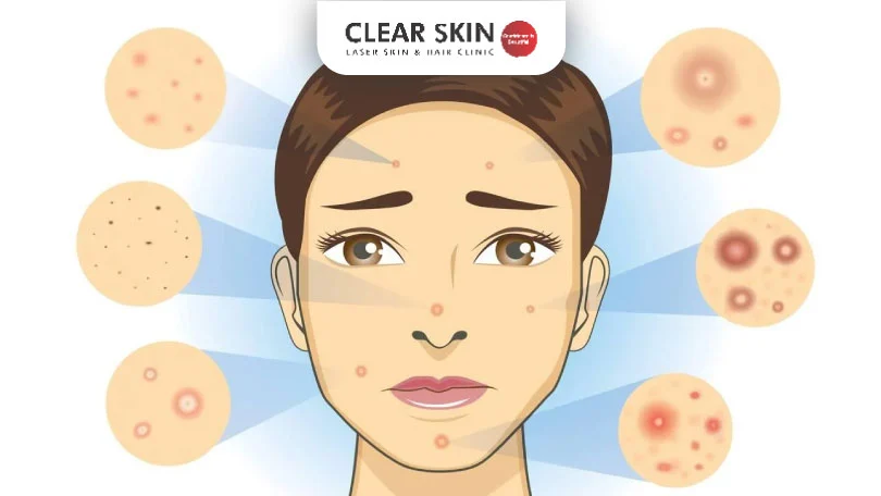 Causes of acne store