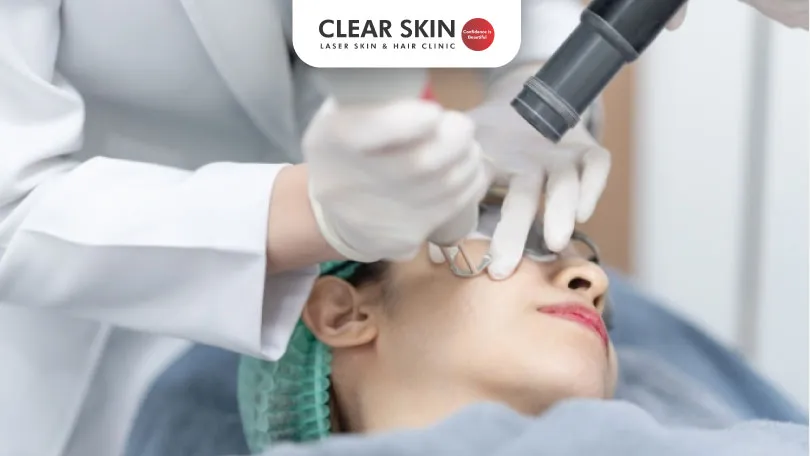 Laser Treatment for Acne Scars – Clear Skin Clinic Pune